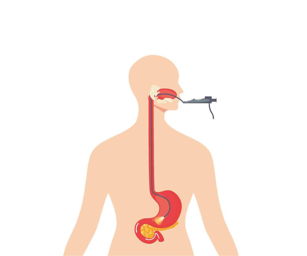 First single-use duodenoscope approved by the FDA - Medical Technology ...