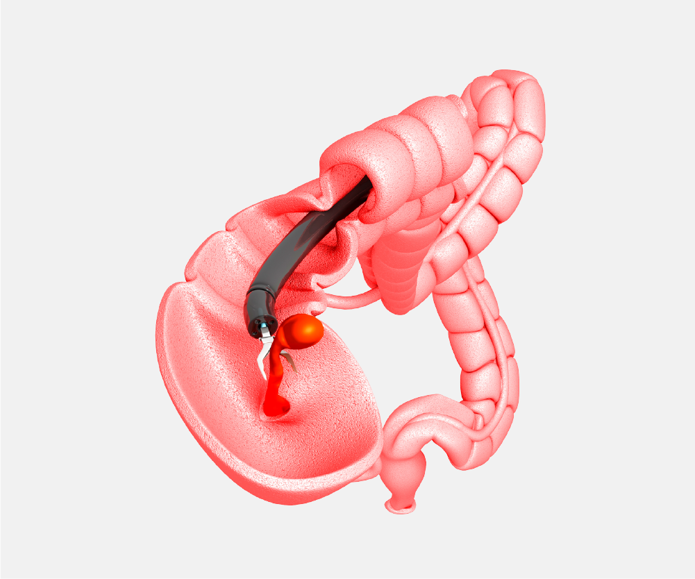 Check-Cap: rethinking the colonoscopy - Medical Technology | Issue 33 ...